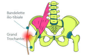 Ressaut latéral de hanche - uneos