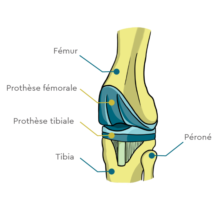 Prothèse Totale de Genou - uneos