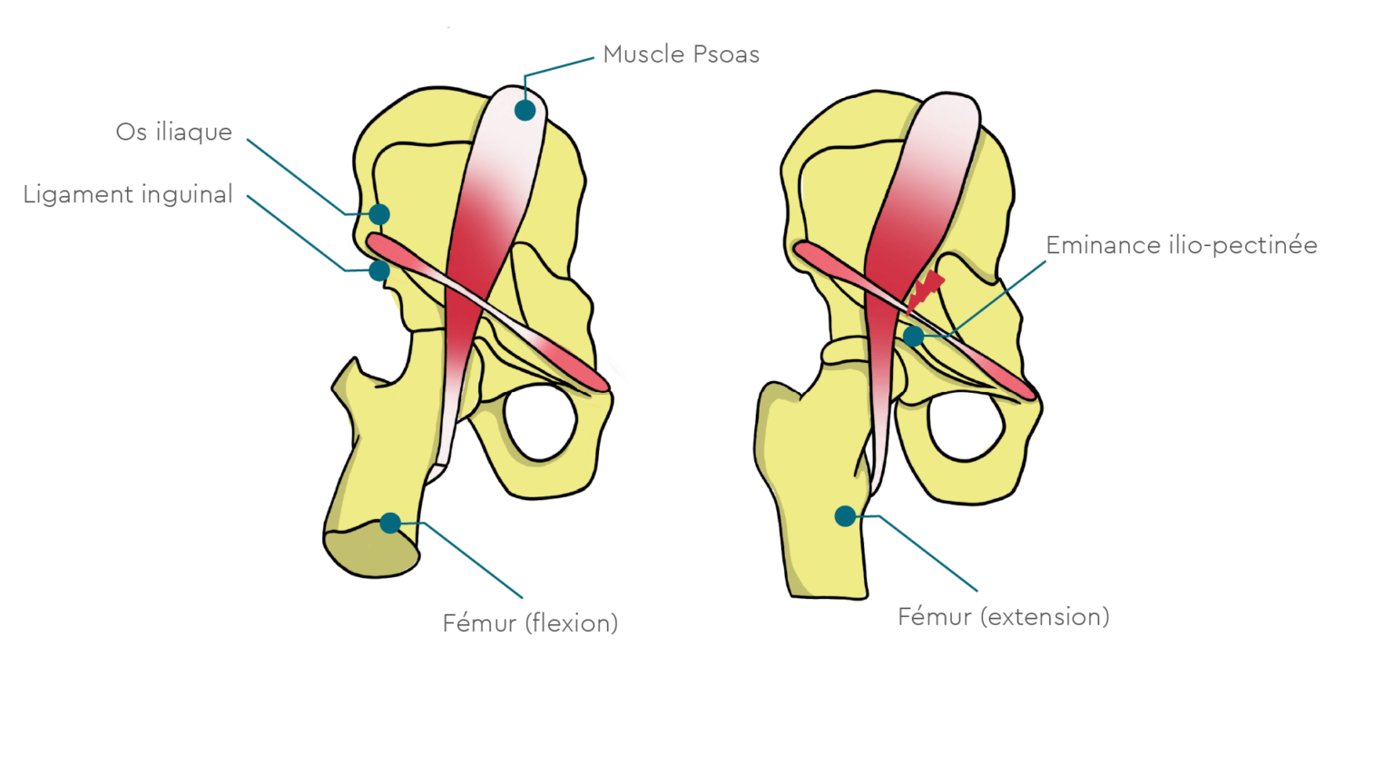 Tendinopathie du psoas - uneos
