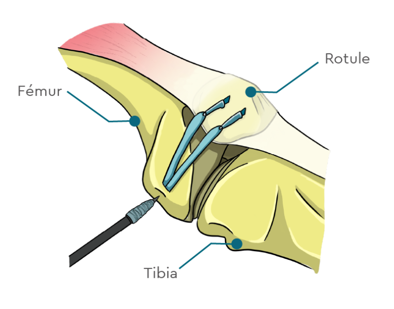 Instabilité rotulienne - uneos