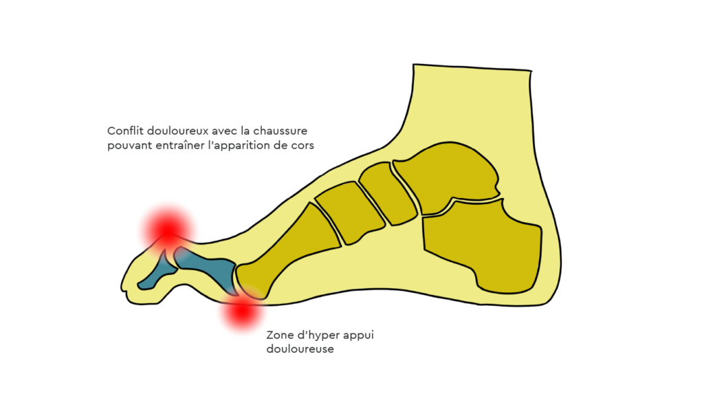 Orteils en griffe - uneos