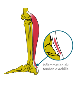 Tendinites d’insertions du tendon d’achille (Enthésopathie d’achille ...