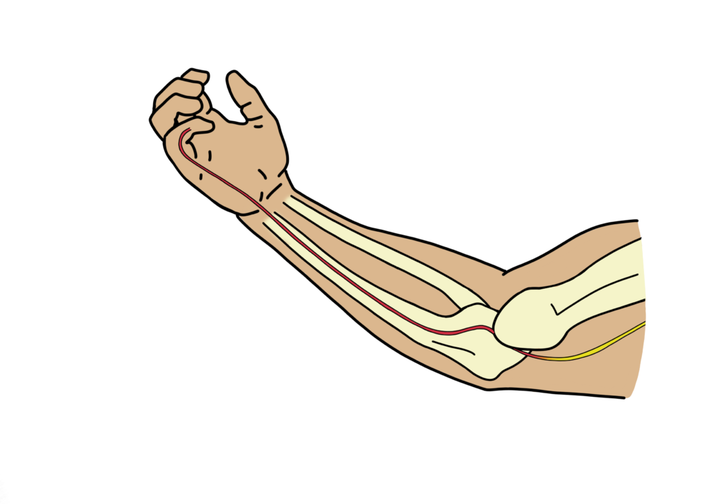 La compression du nerf ulnaire - uneos