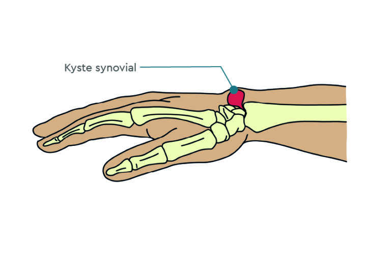 Le kyste synovial - uneos